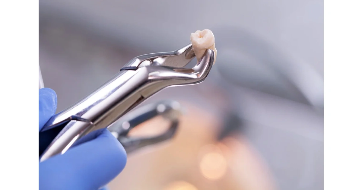 Tooth Extractions in Orlando, FL | Windermere Dental Spa